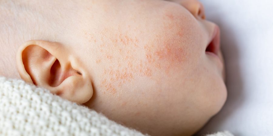 Brotoeja em bebê: como reduzir o desconforto dos pequenos